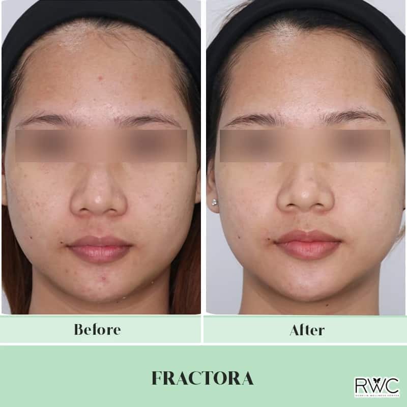 FRACTORA นวัตกรรมใหม่ล่าสุด ของการรักษาหลุมสิวที่ดีที่สุดในตอนนี้
