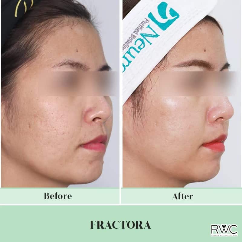 FRACTORA นวัตกรรมใหม่ล่าสุด ของการรักษาหลุมสิวที่ดีที่สุดในตอนนี้