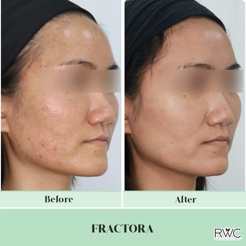 FRACTORA นวัตกรรมใหม่ล่าสุด ของการรักษาหลุมสิวที่ดีที่สุดในตอนนี้