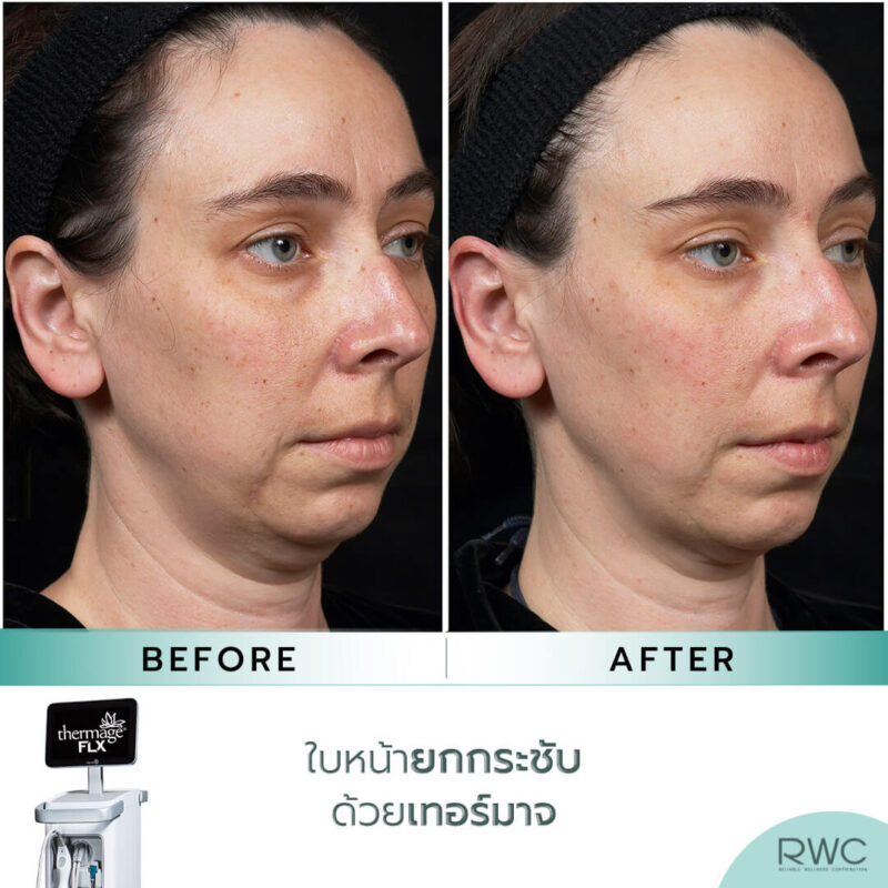 รวมวิธี ปรับรูปหน้า RWC อยากหน้าเรียวต้องเลือกแบบไหนถึงจะเหมาะ?